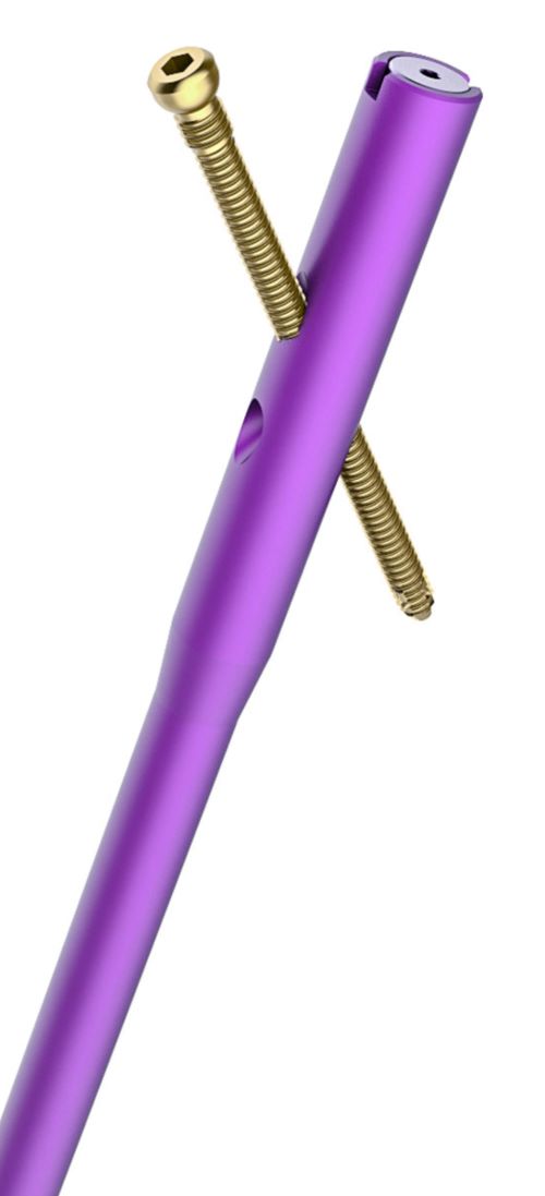 Clavos endomedulares – CDH PROTESIS E IMPLANTES
