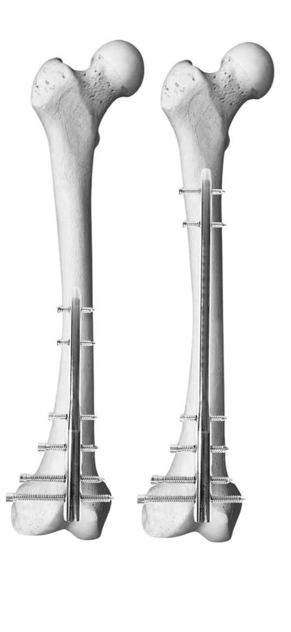 Clavos endomedulares – CDH PROTESIS E IMPLANTES