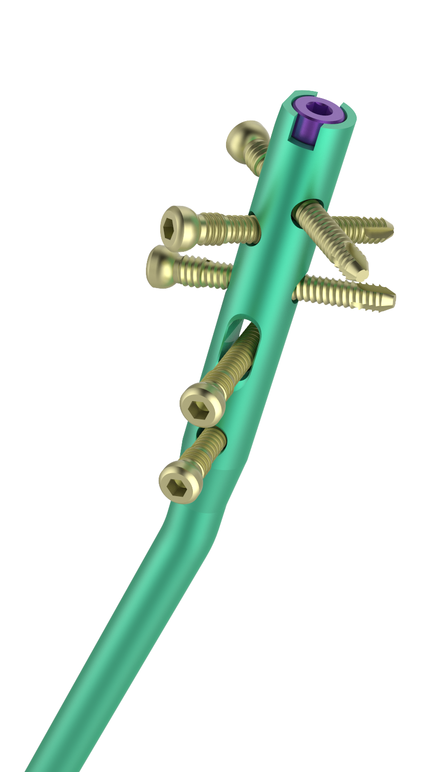 Clavos endomedulares – CDH PROTESIS E IMPLANTES